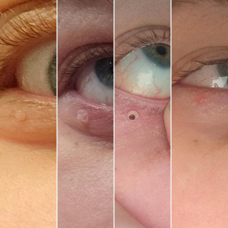 TagBuddy Kit™ - No More Skin Tags