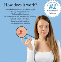 TagBuddy Kit™ - No More Skin Tags