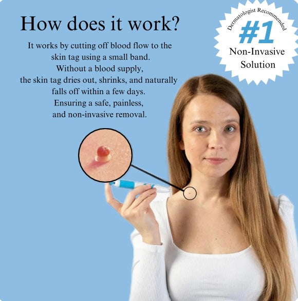 TagBuddy Kit™ - No More Skin Tags